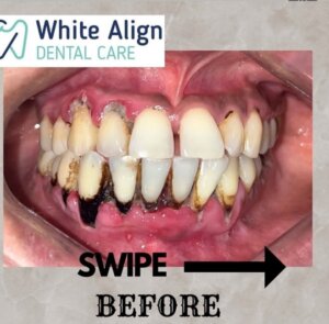 Teeth Scaling and Polishing: Benefits, Procedure, and Aftercare